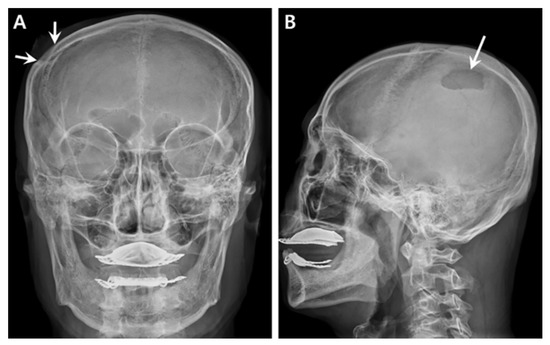 Chronic Intradiploic Organizing Hematoma of the Skull Mimicking ...