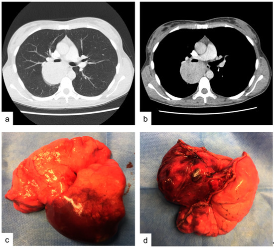 Pulmonary Sclerosing Pneumocytoma: A Pre and Intraoperative Diagnostic ...