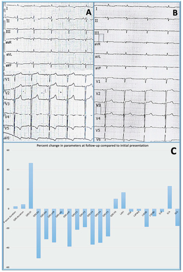 Cardiac Amyloidosis with Discordant QRS Voltage between Frontal and ...