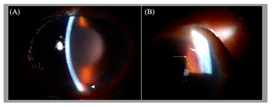 Ocular Decompression Retinopathy after Anterior Chamber Paracentesis ...