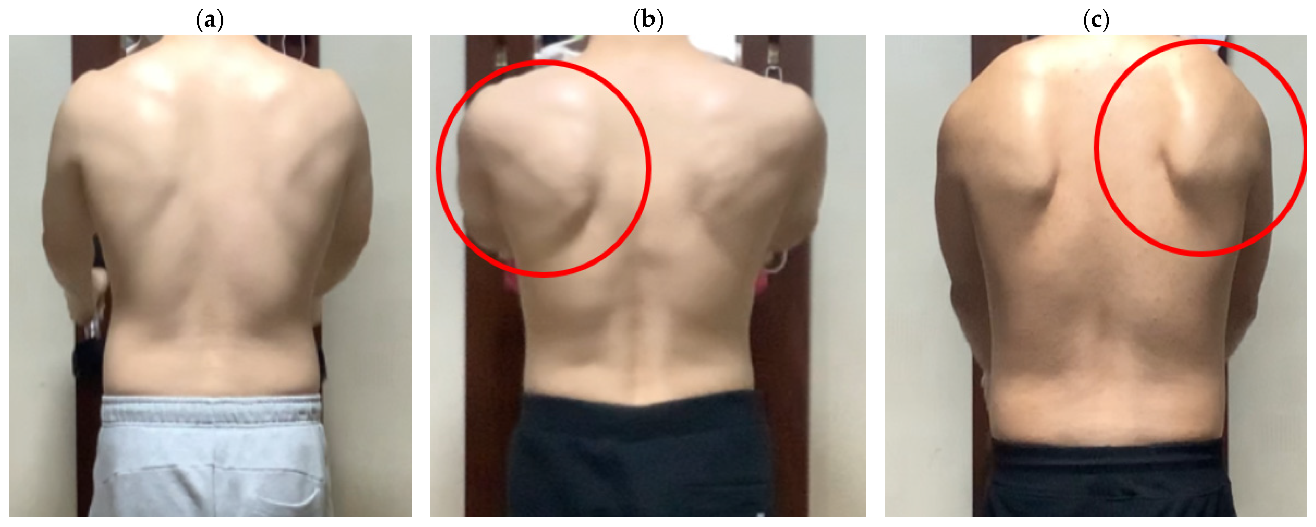 Medicina Free Full Text Scapular Dyskinesis In Elite Boxers With Medicina Free Full Text Scapular Dyskinesis In Elite Boxers With