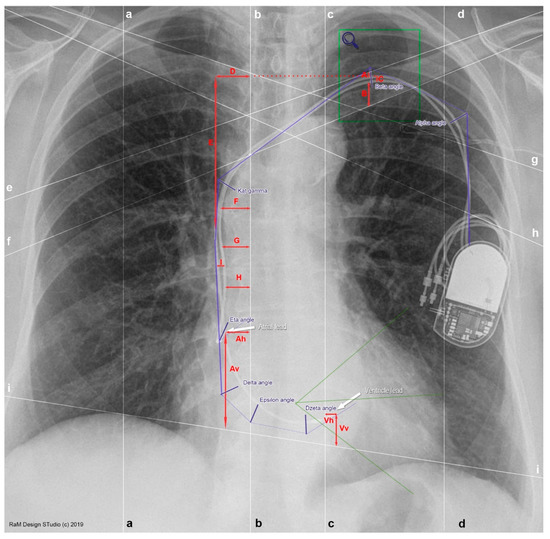 New Method of Cardiac Lead Evaluation Using Chest Radiography