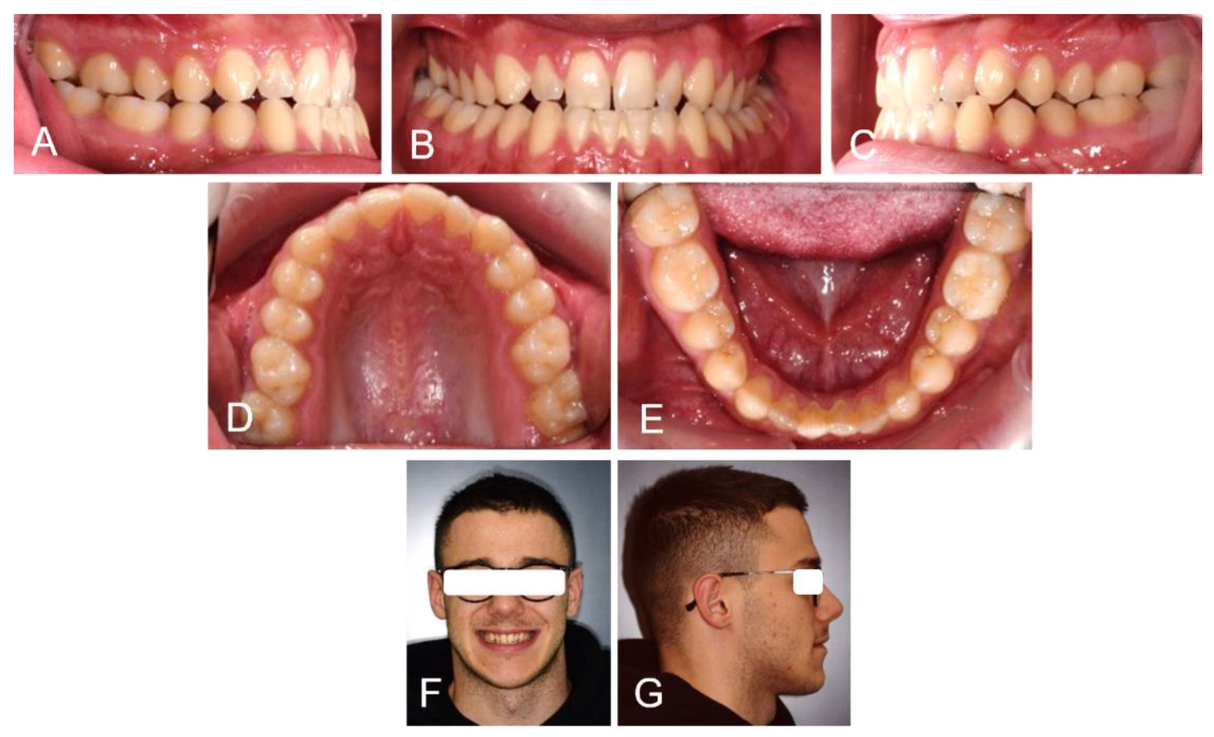 Medicina Free Full Text Treatment Of Class III Malocclusion And Medicina Free Full Text Treatment Of Class III Malocclusion And