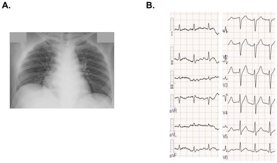 A Rescue Use of ECPELLA for Sepsis-Induced Cardiogenic Shock Followed ...