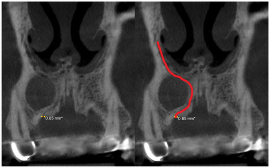 Prevalence, Radiographic Features and Clinical Relevancy of Accessory ...