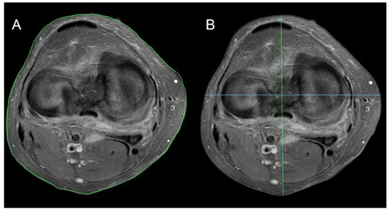 Knee Diameter and Cross-Section Area Measurements in MRI as New ...