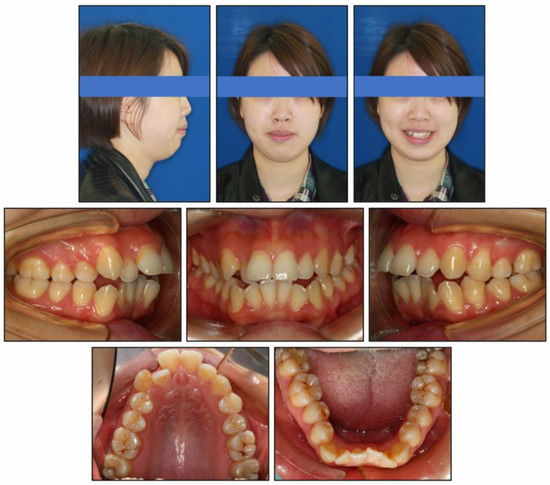 Vertical Control of a Severe Hyperdivergent Skeletal Class II ...