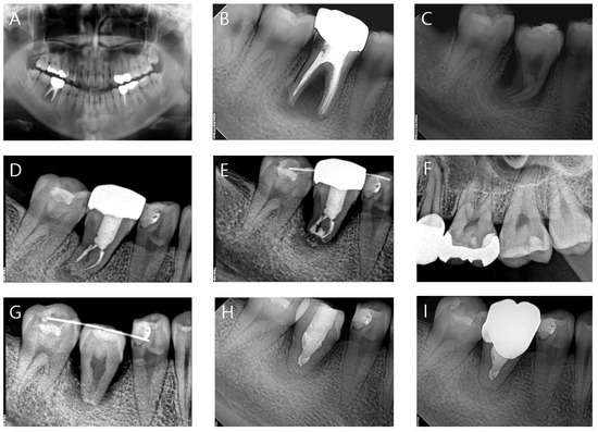 Long-Term Survival Rate of Autogenous Tooth Transplantation: Up to 162 ...