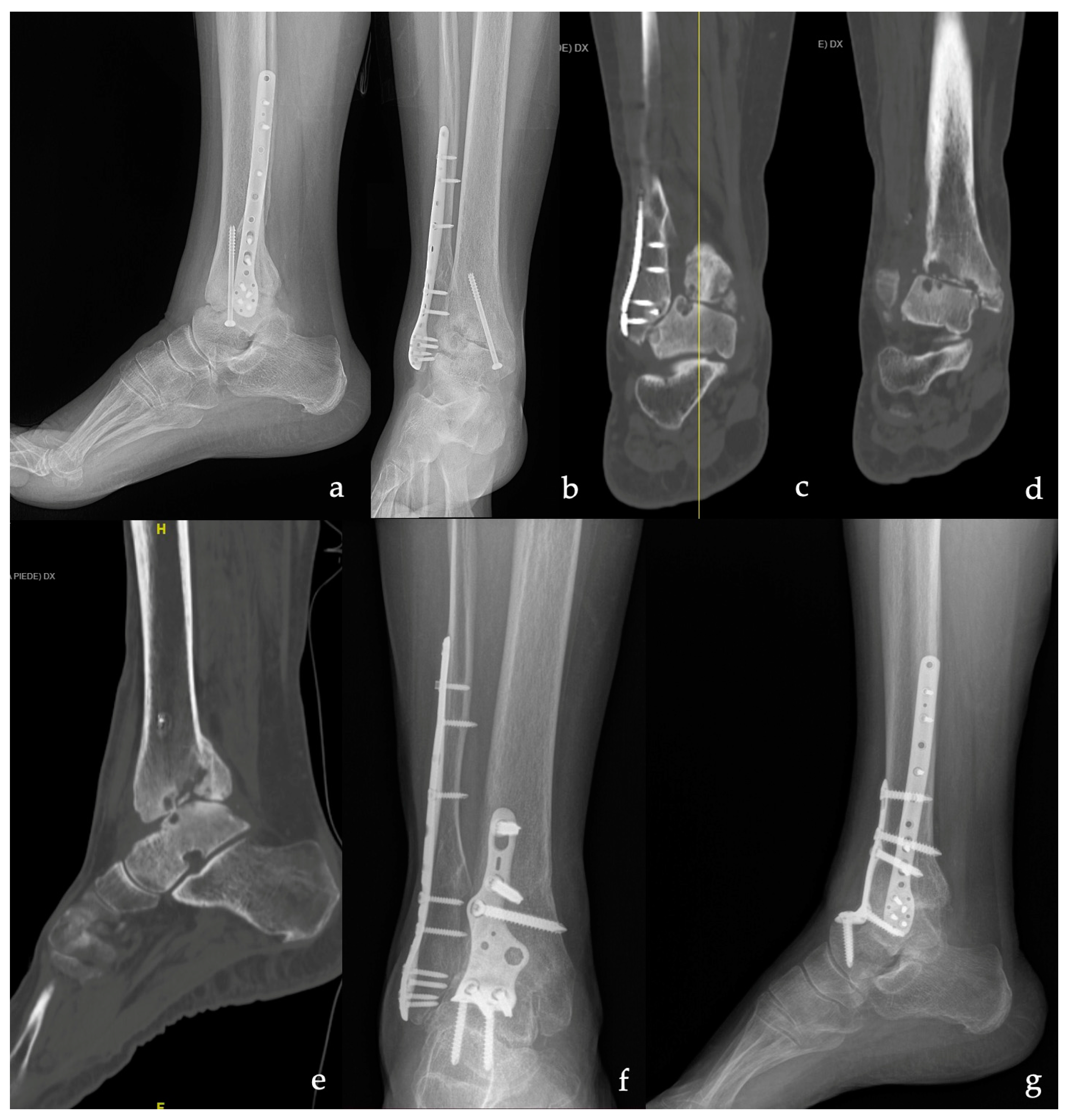 Tibiotalar And Tibiotalocalcaneal Arthrodesis With Paragon28 Tibiotalar And Tibiotalocalcaneal Arthrodesis With Paragon28