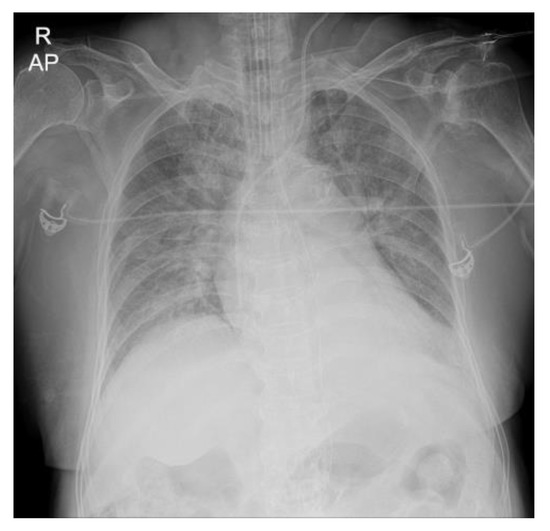 Unexpected Tension Pneumothorax after Double-Lumen Endotracheal ...