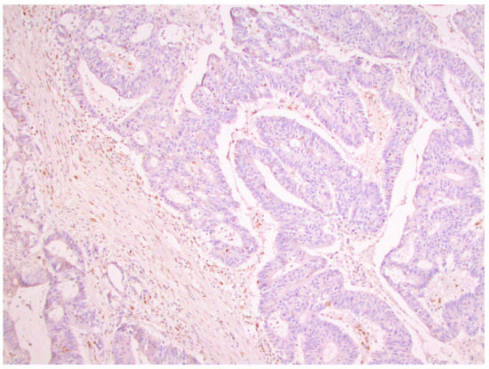 The Importance of Immunohistochemical Heterogeneous Expression of MMR ...