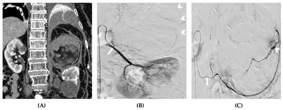 Transcatheter Arterial Embolization (TAE) of Cancer-Related Bleeding