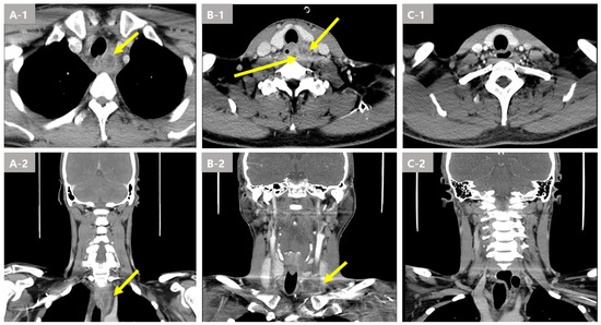 Two Cases of Severe Complications Due to an Esophageal Fish Bone ...