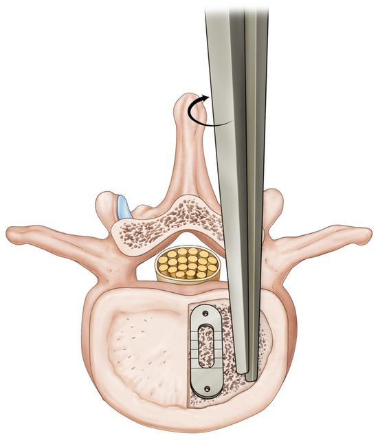 Medicina | Free Full-Text | Comparison of Unilateral versus Bilateral ...