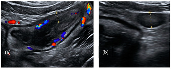 Gastrointestinal Ultrasound in Infectious Diseases: A Comprehensive Review