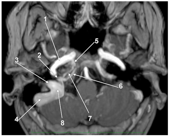 Anatomical Variations of the Jugular Bulb: A Critical and Comprehensive ...