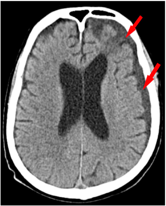 Gerstmann Syndrome in an Elderly Patient: A Case Report Presented with ...