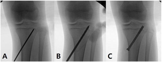 Hemi-Percutaneous Epiphysiodesis Using Transphyseal Screws at Lateral ...