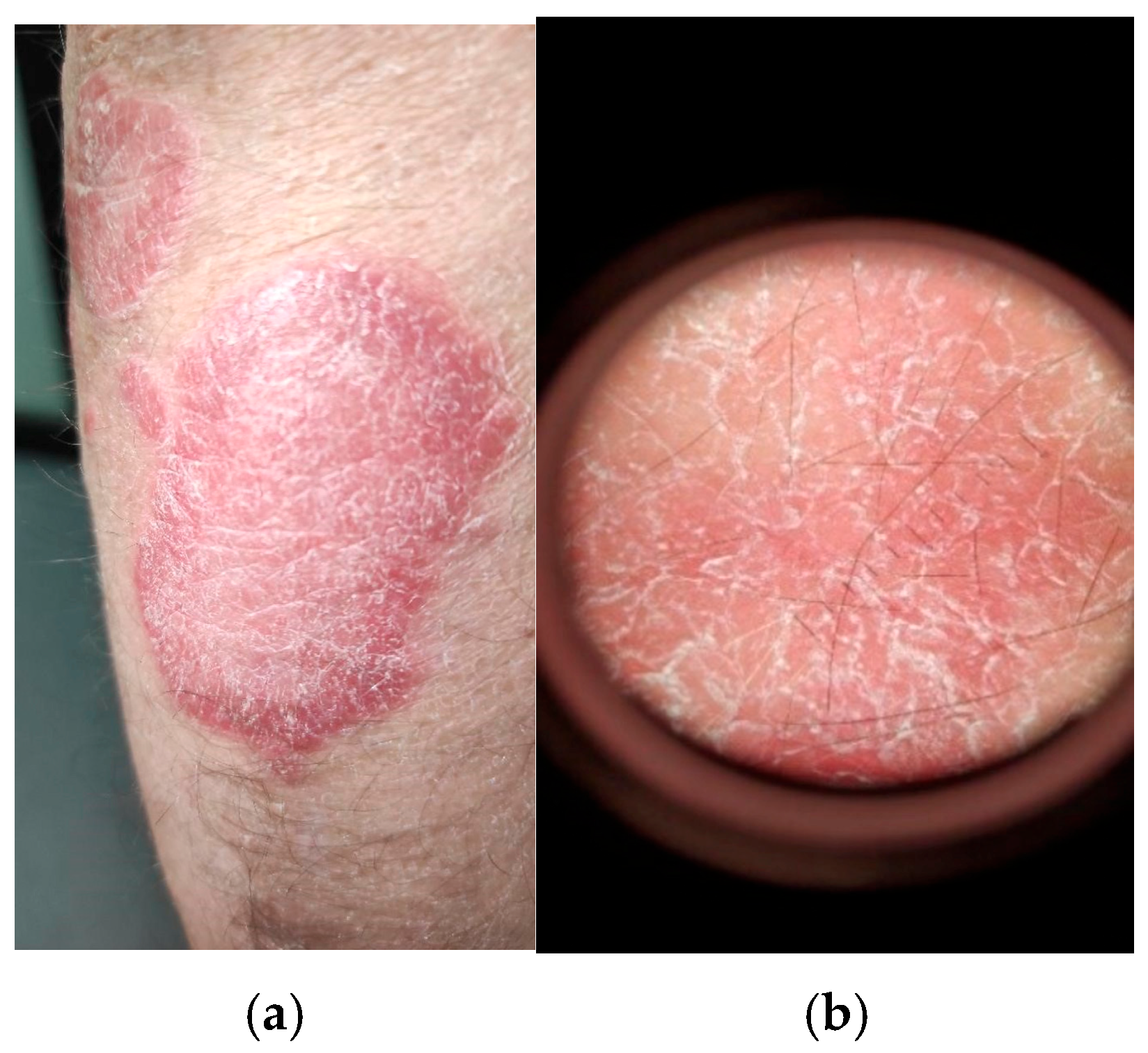 The Role of Dermoscopy and High-Frequency Ultrasonography in the ...