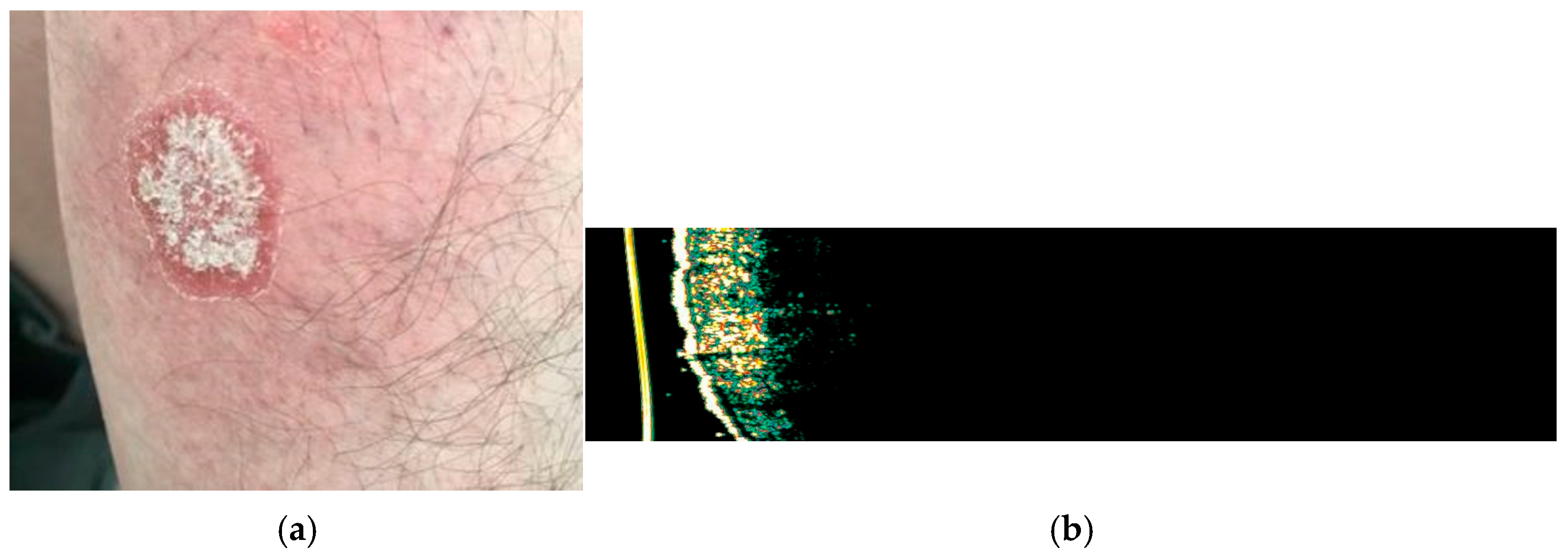 The Role of Dermoscopy and High-Frequency Ultrasonography in the ...
