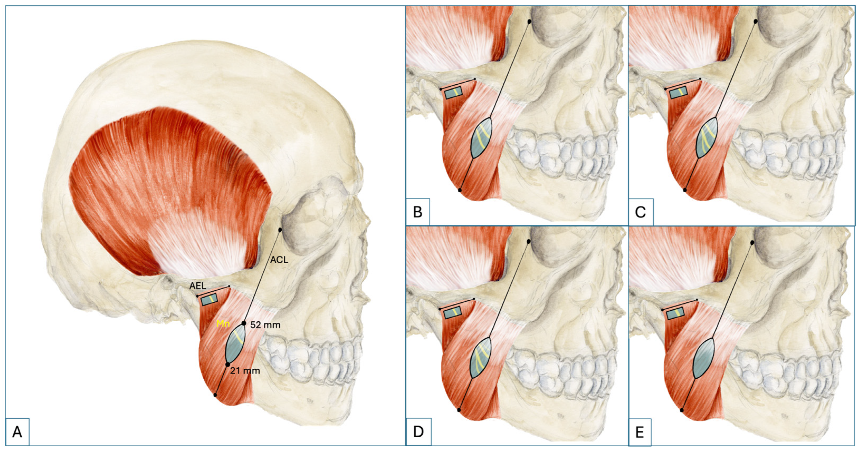 Mapping the Masseteric Nerve for Facial Reanimation: An Anatomical ...