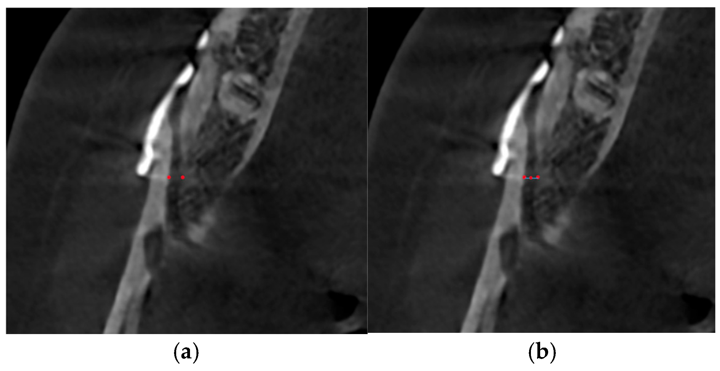 Cone-Beam Computed Tomography Evaluation of Bone Density After Sagittal ...