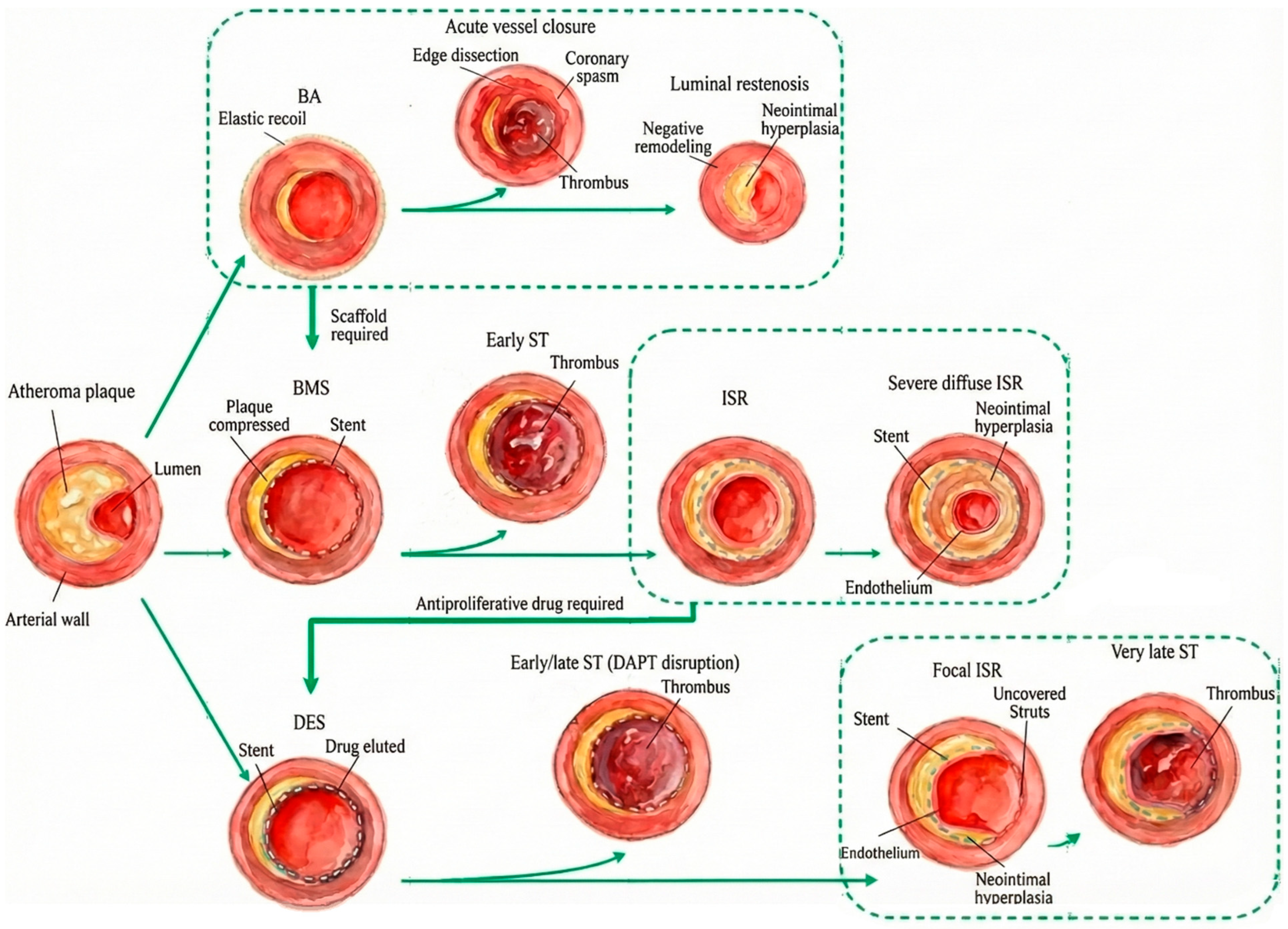 In-Stent Restenosis Pathophysiology and Risk Factors: A Comprehensive ...