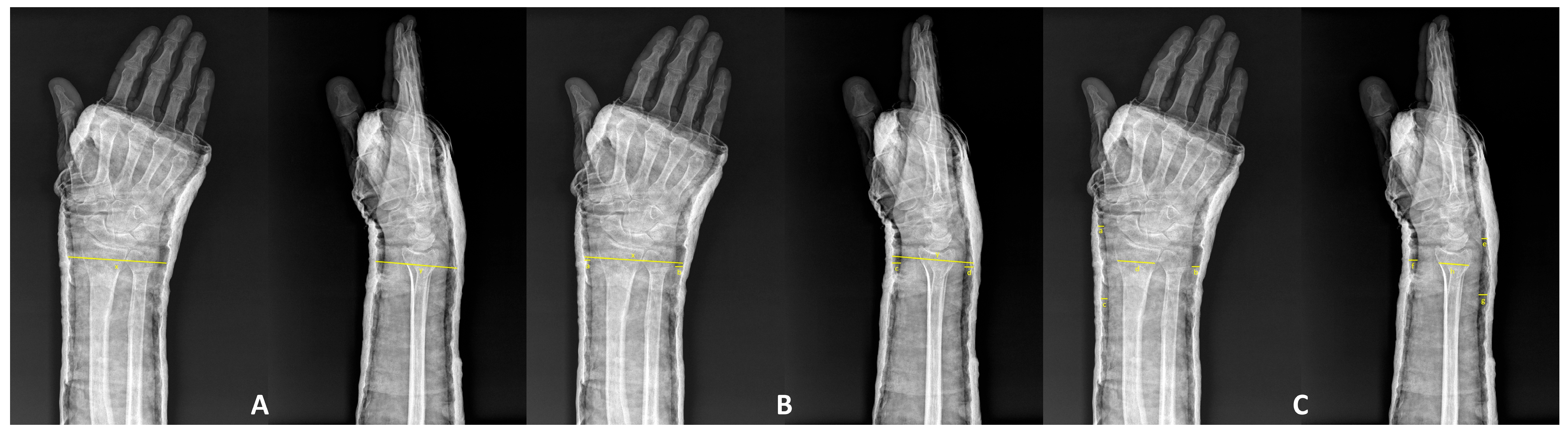 Comparative Discriminative Performance of Cast, Gap, and Three-Point ...