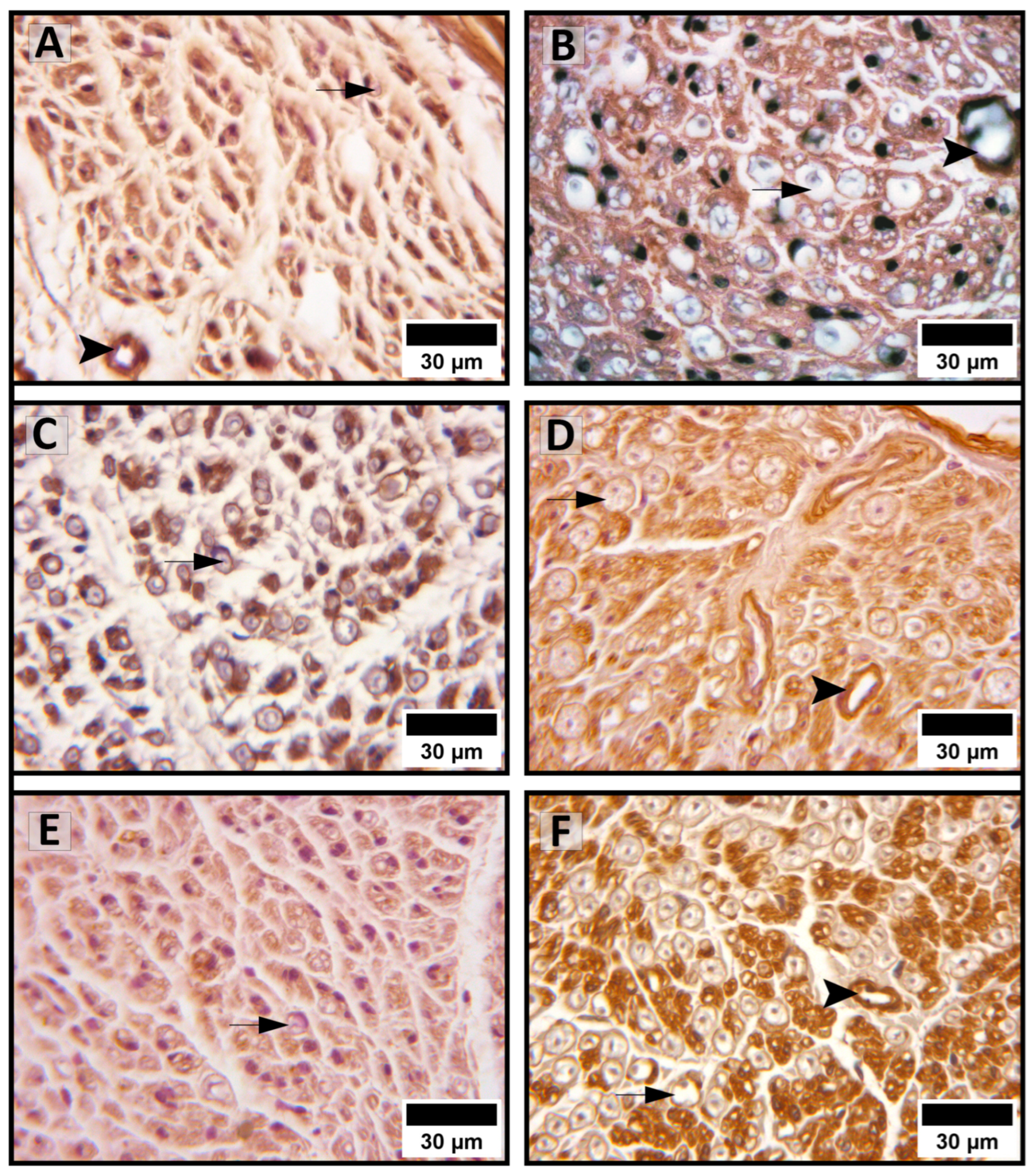 Extracellular Matrix Remodelling in the Human Sural Nerve in Peripheral ...