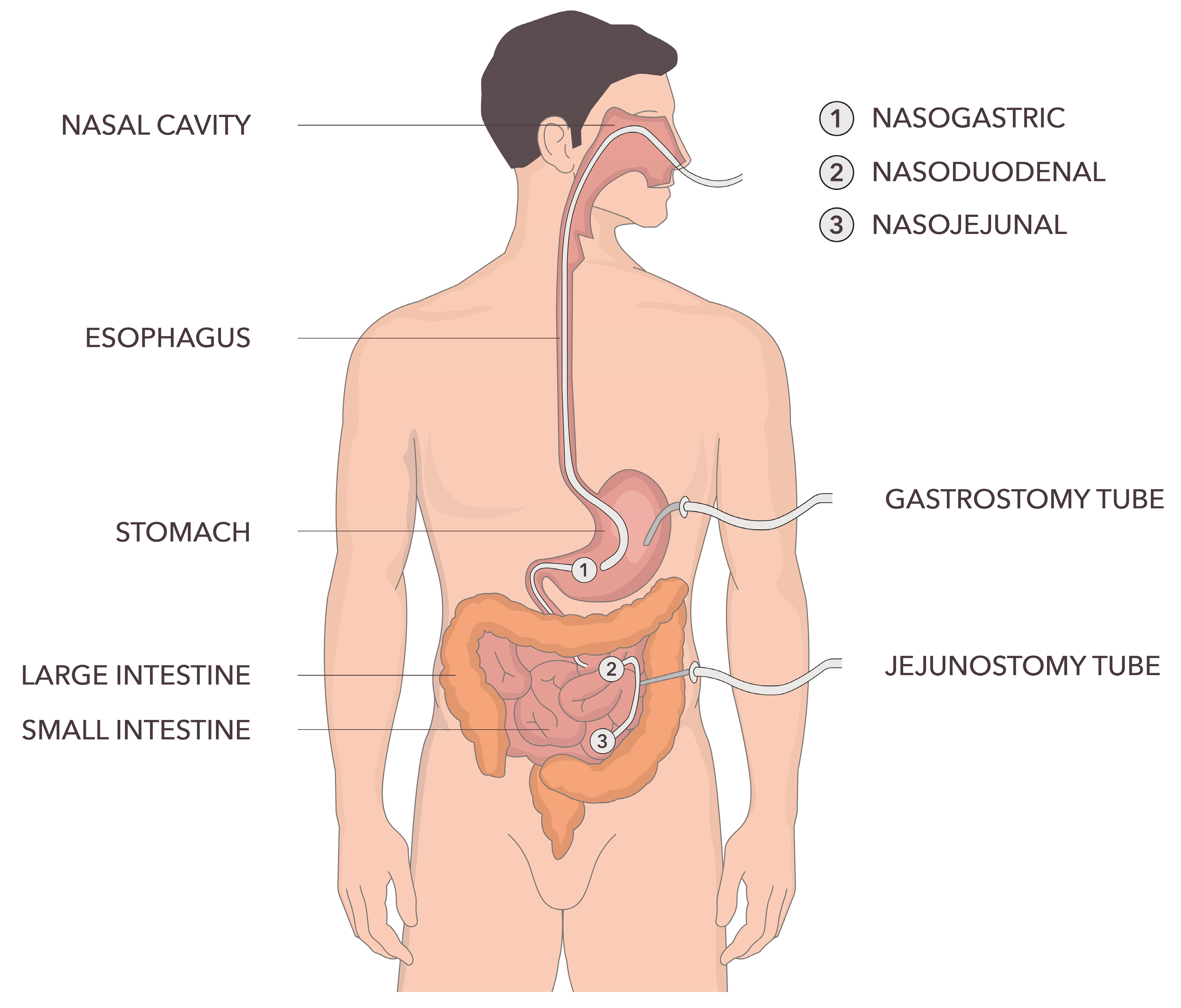 Enteral Feeds: Benefits and Drawbacks Associated with Blenderized Feeds ...