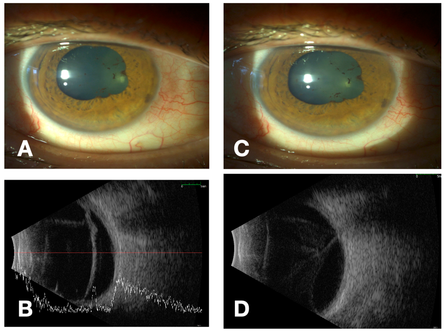 Syphilitic Panuveitis and Rhegmatogenous Retinal Detachment: Diagnostic ...