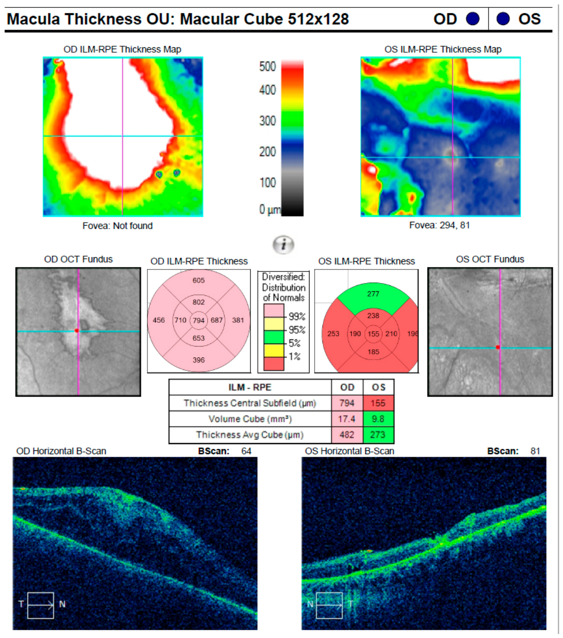 Syphilitic Panuveitis and Rhegmatogenous Retinal Detachment: Diagnostic ...