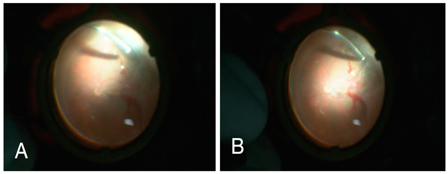 Syphilitic Panuveitis and Rhegmatogenous Retinal Detachment: Diagnostic ...