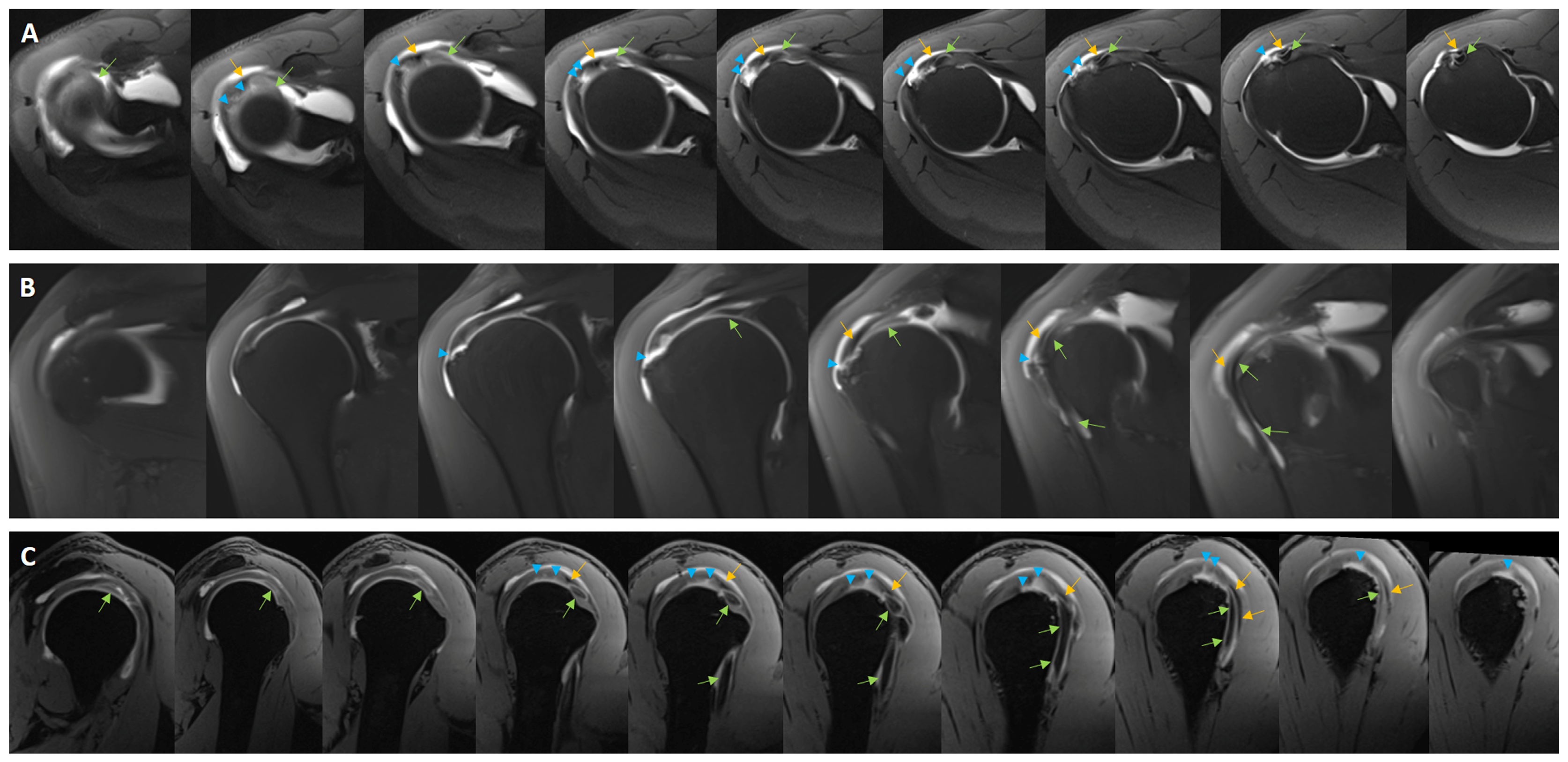 Significance of the Aponeurotic Expansion of the Supraspinatus Tendon ...