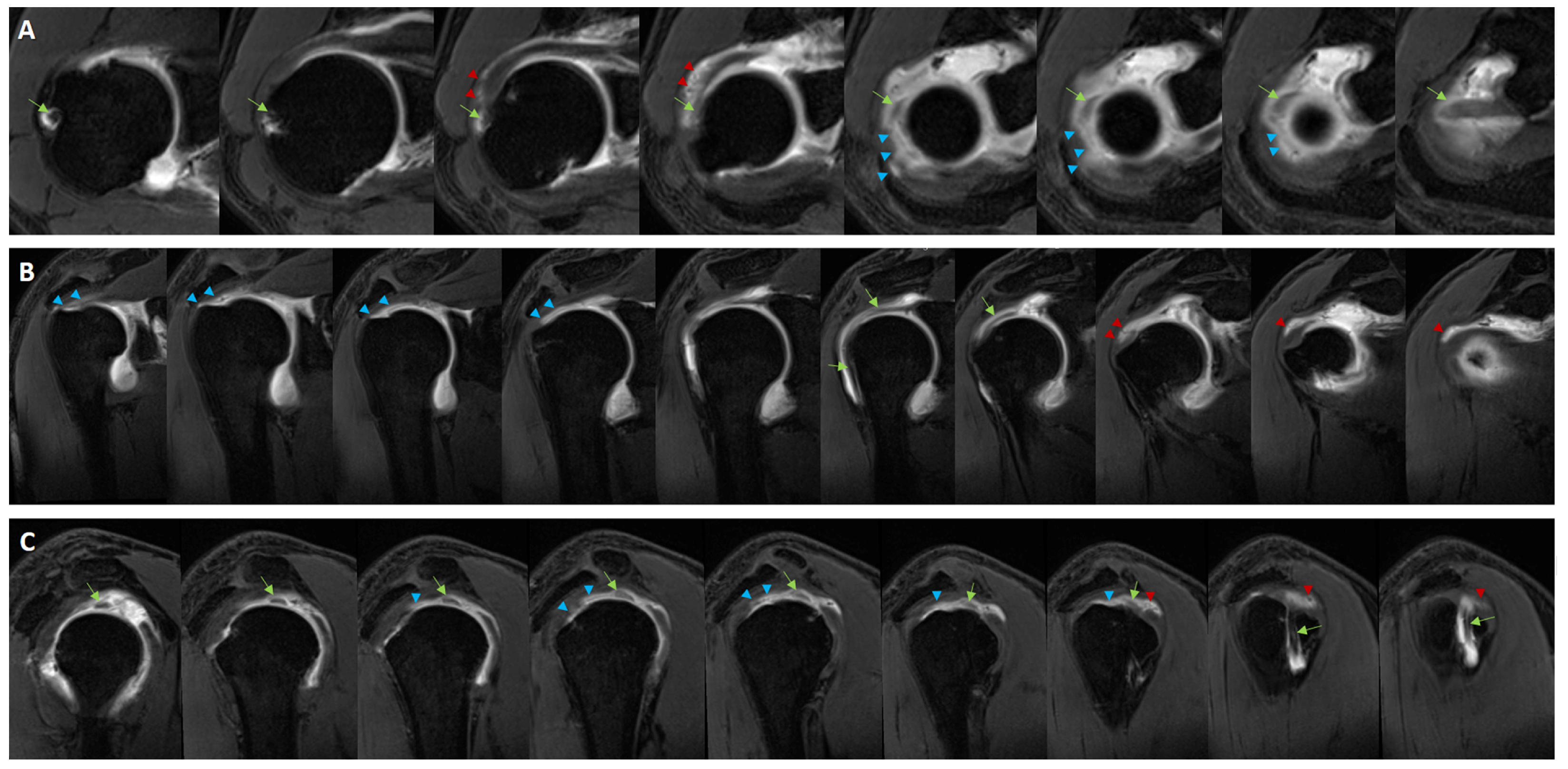 Significance of the Aponeurotic Expansion of the Supraspinatus Tendon ...