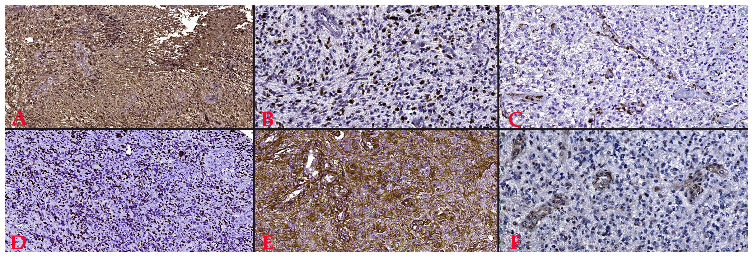Consequences of Hypoxic Events, Necrosis, and Microvascular Density, in ...