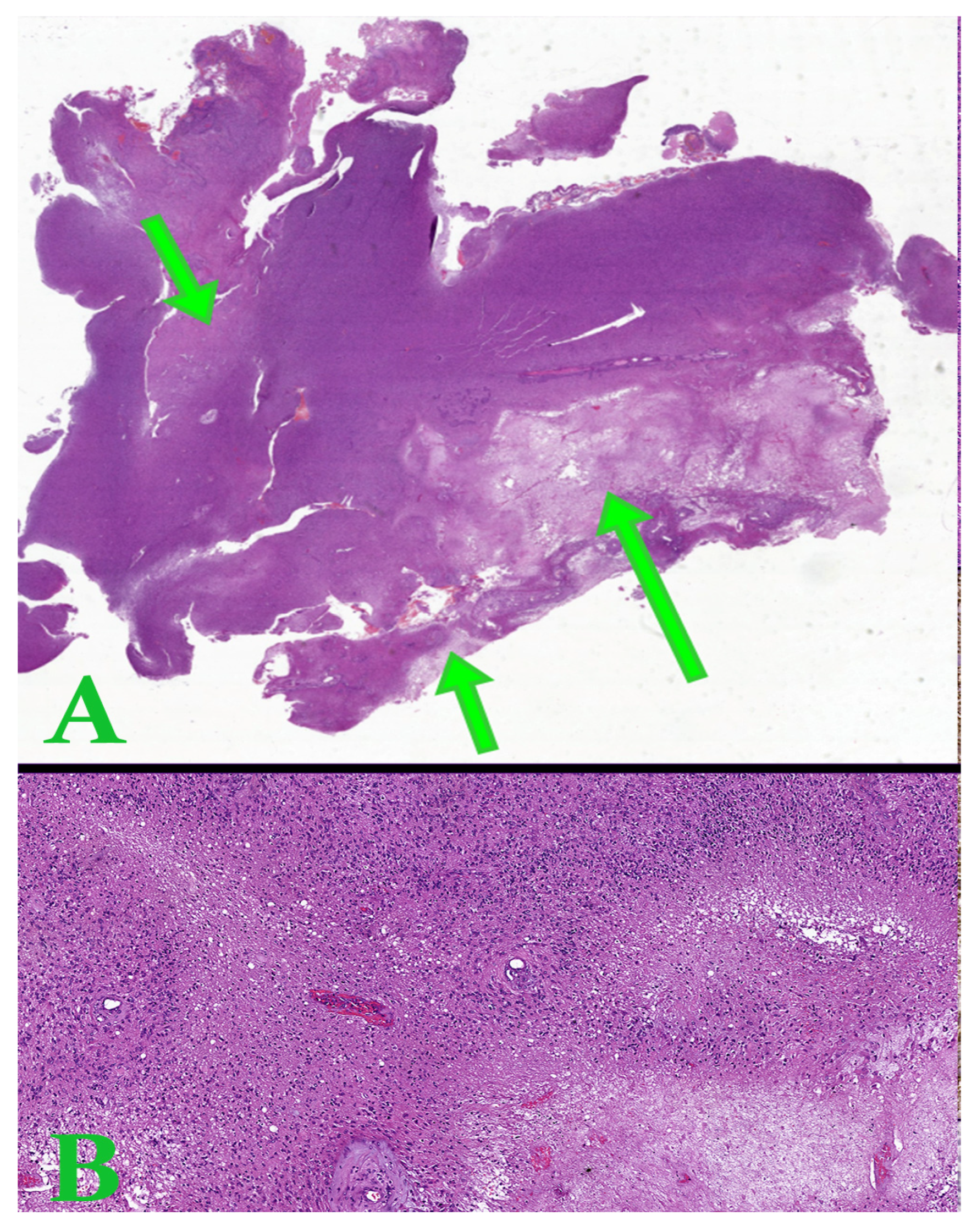 Consequences of Hypoxic Events, Necrosis, and Microvascular Density, in ...