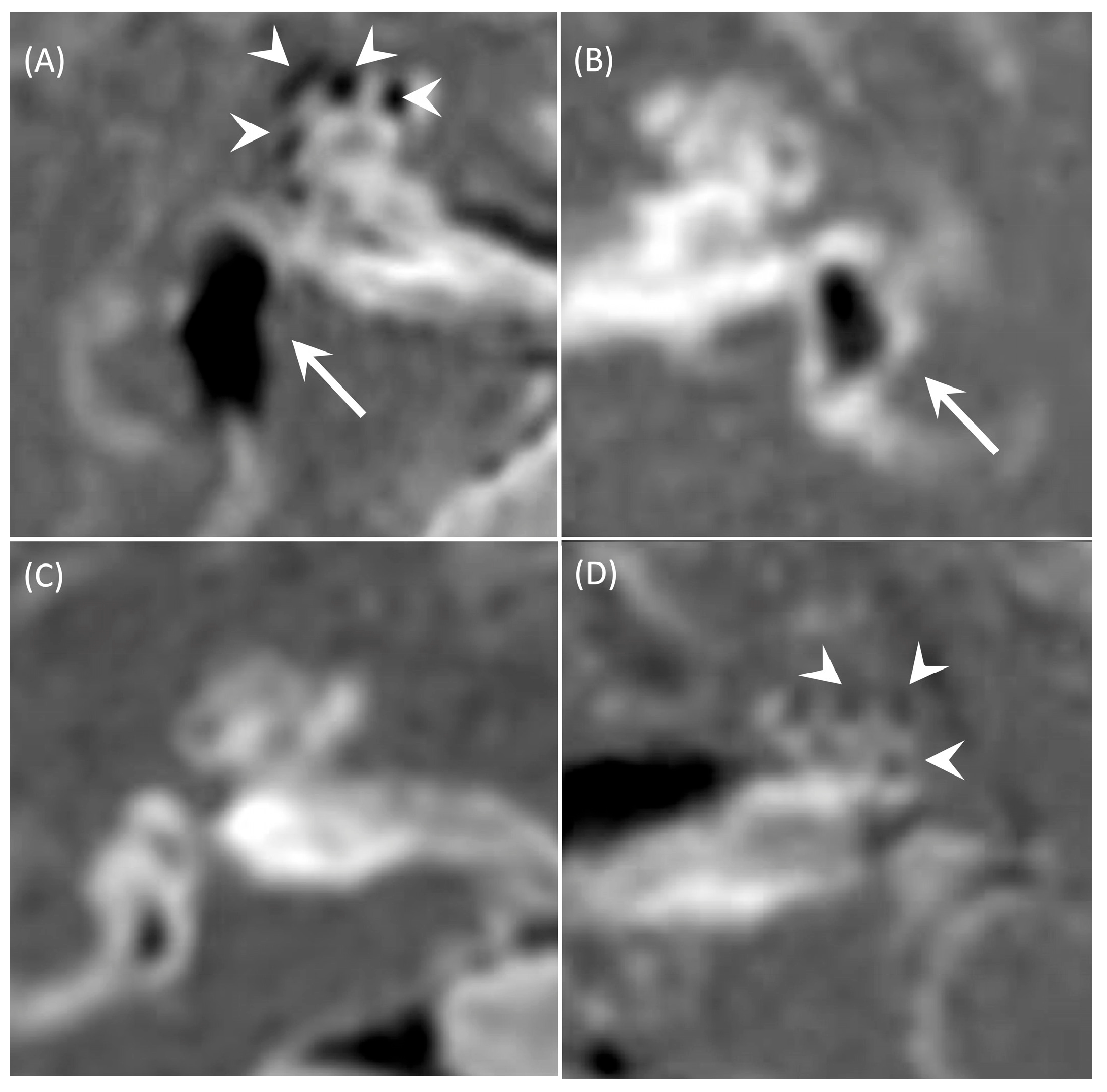 Characterizing Differences in Endolymphatic Hydrops Signatures Among ...