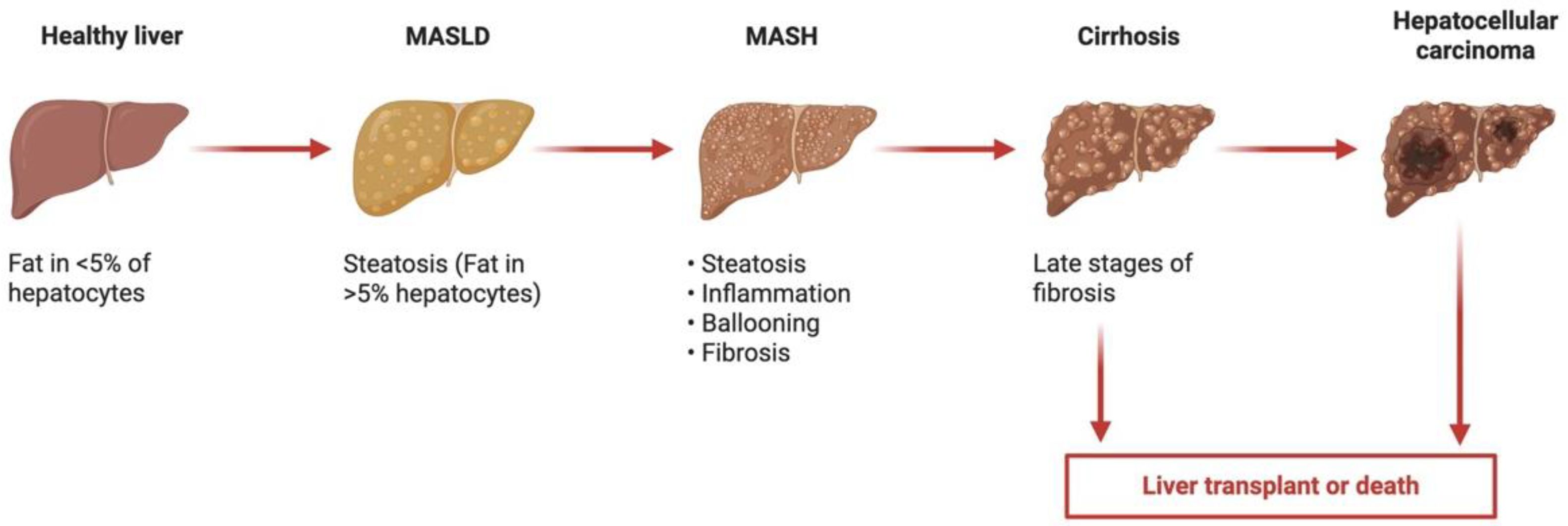 Efficacy and Safety of Statins in MASLD and Other Chronic Liver Diseases