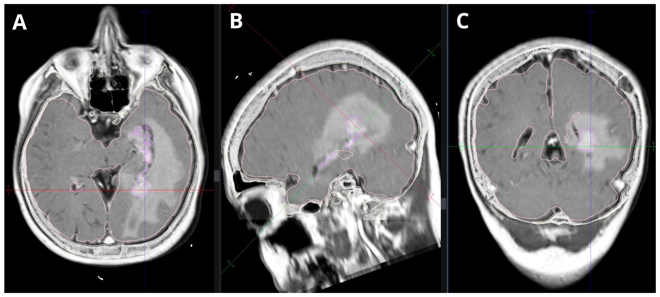 Lymphoma Related to the Ventricular System: A Rare Case Report and ...