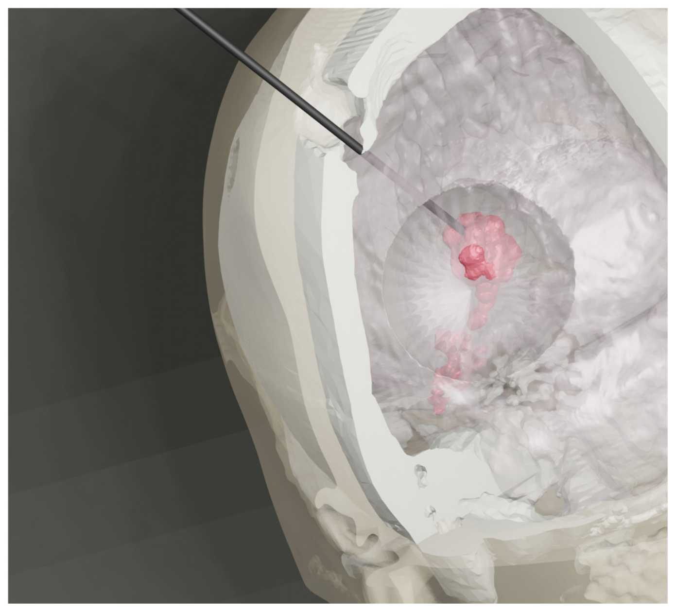 Lymphoma Related to the Ventricular System: A Rare Case Report and ...