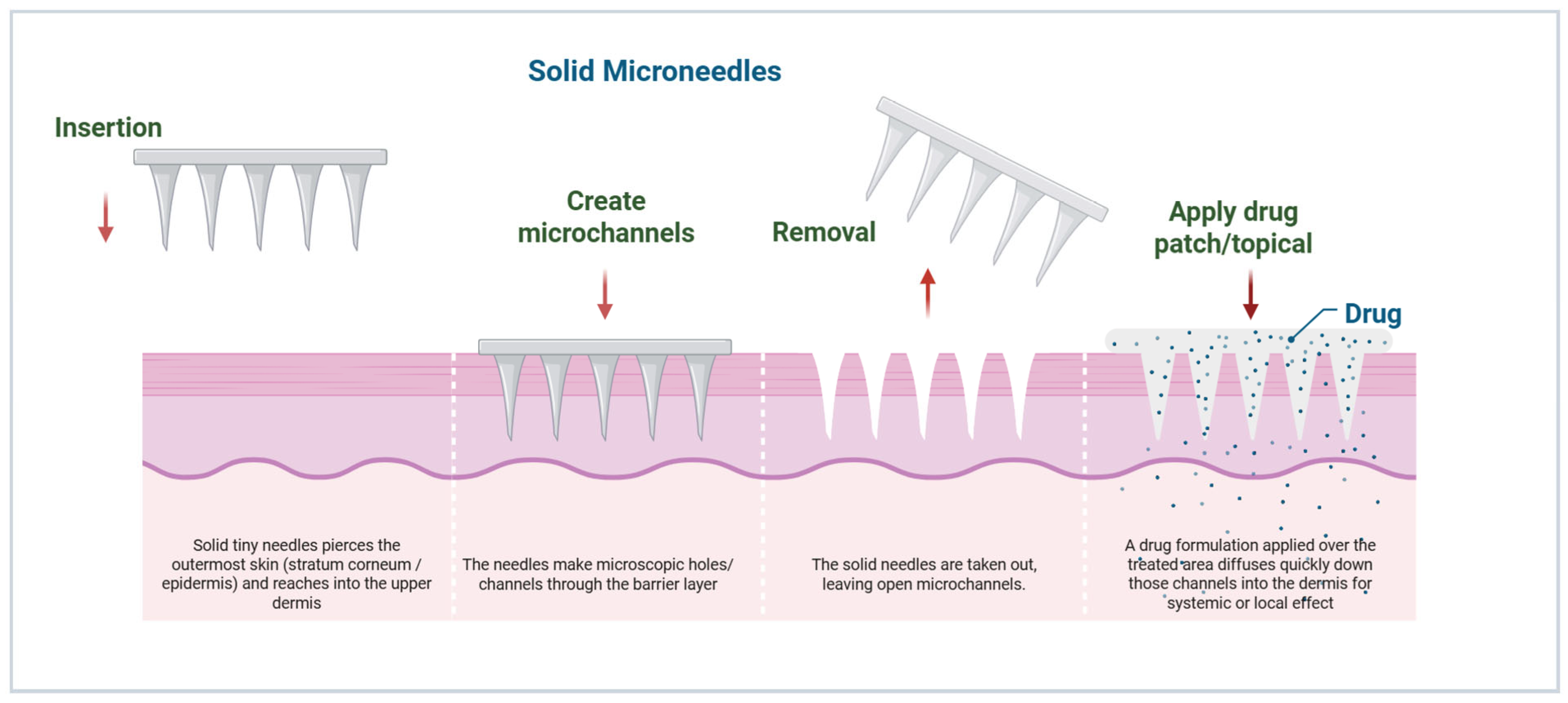 Microneedle Technologies for Drug Delivery: Innovations, Applications ...