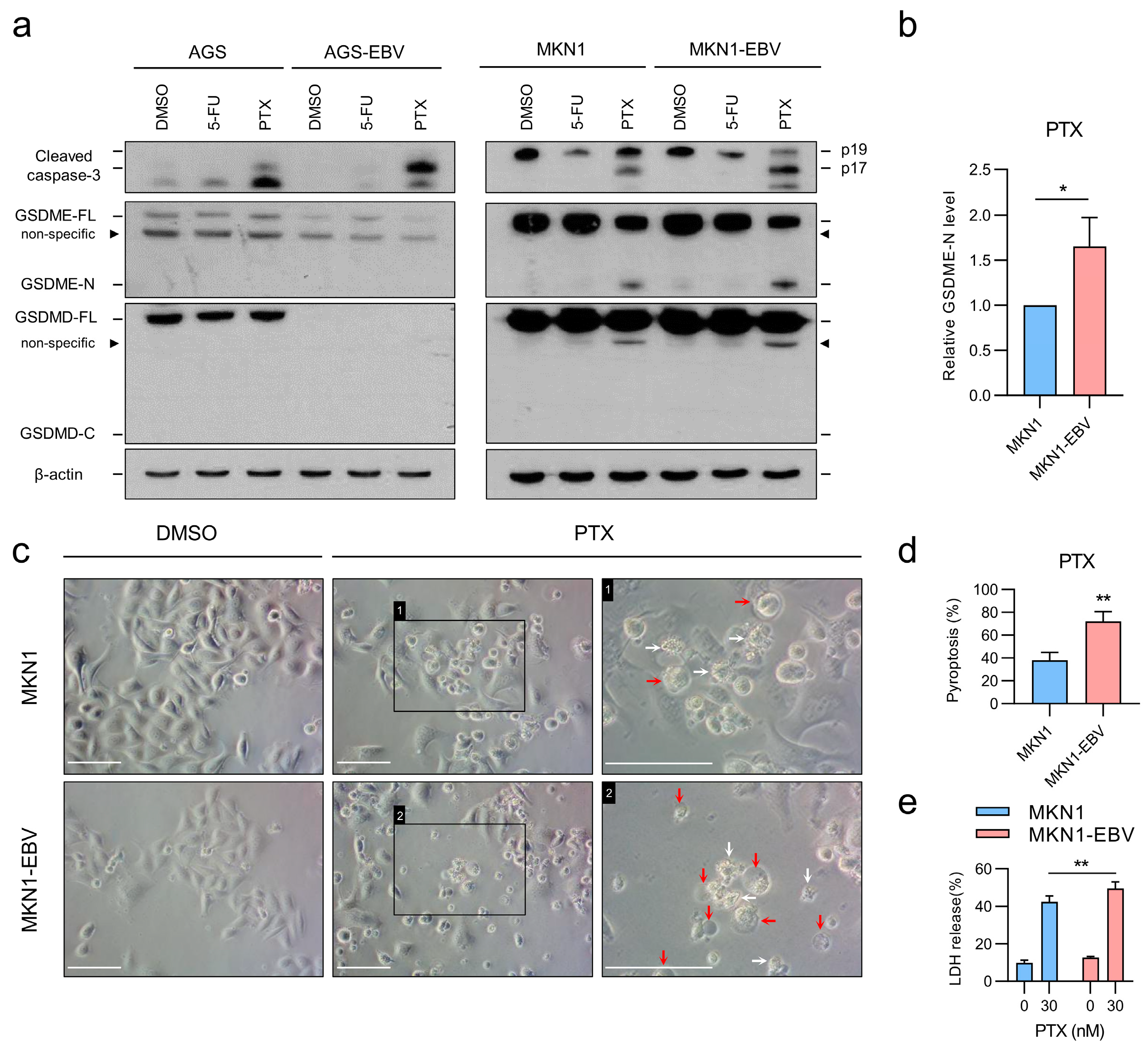 Epstein–Barr Virus Silences GSDME and Pyroptosis in Gastric Cancer