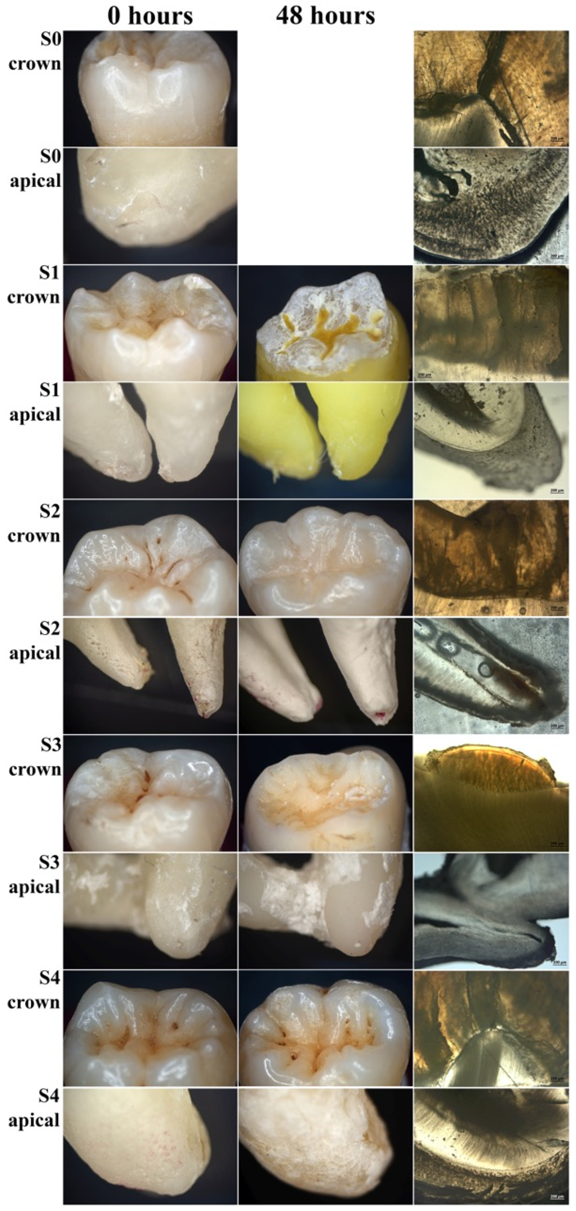 Tracing Corrosive Damage in Human Teeth: A Forensic Pilot Study of ...