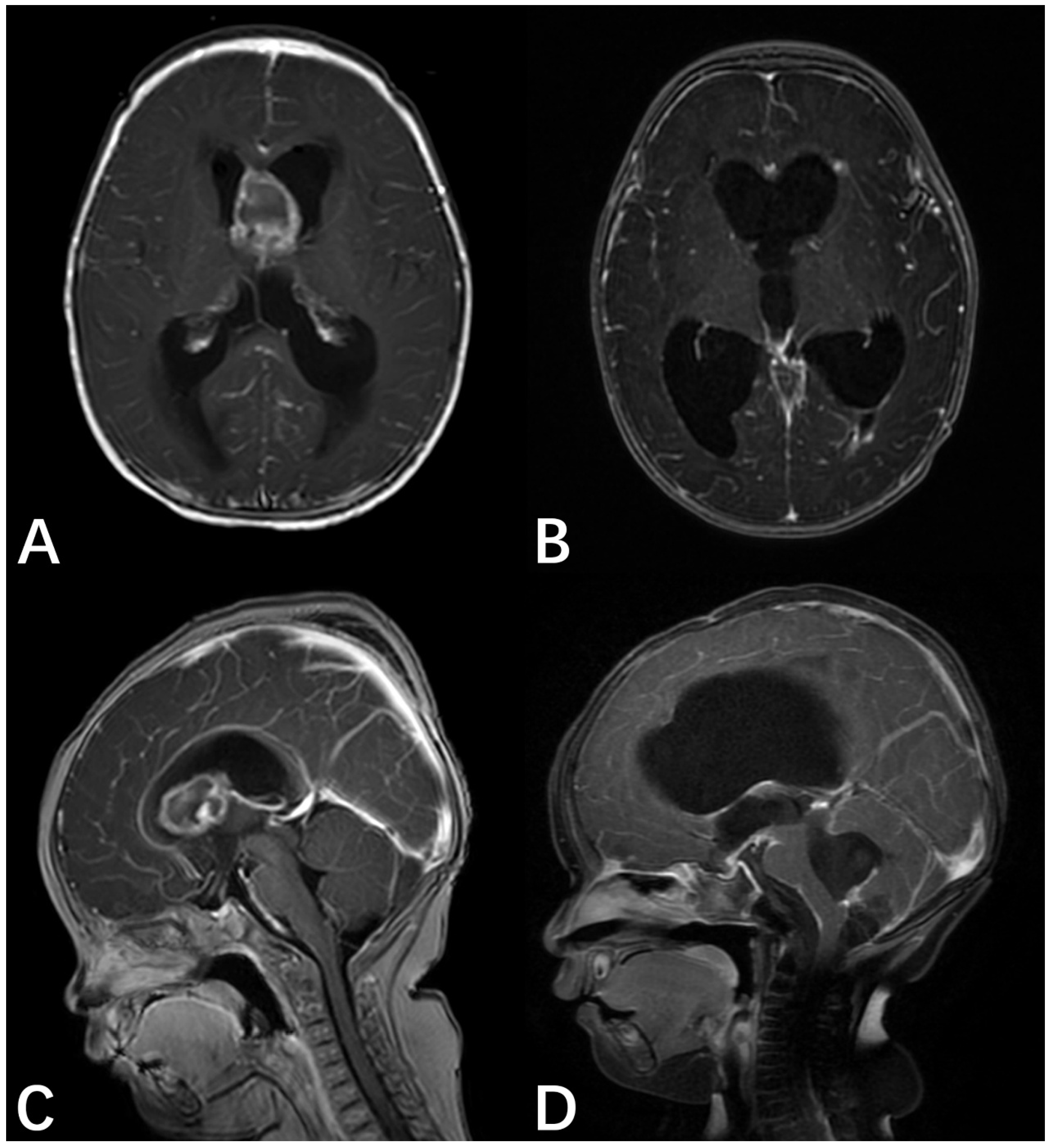 Atypical Teratoid/Rhabdoid Tumor of the Lateral Ventricle: A Case ...