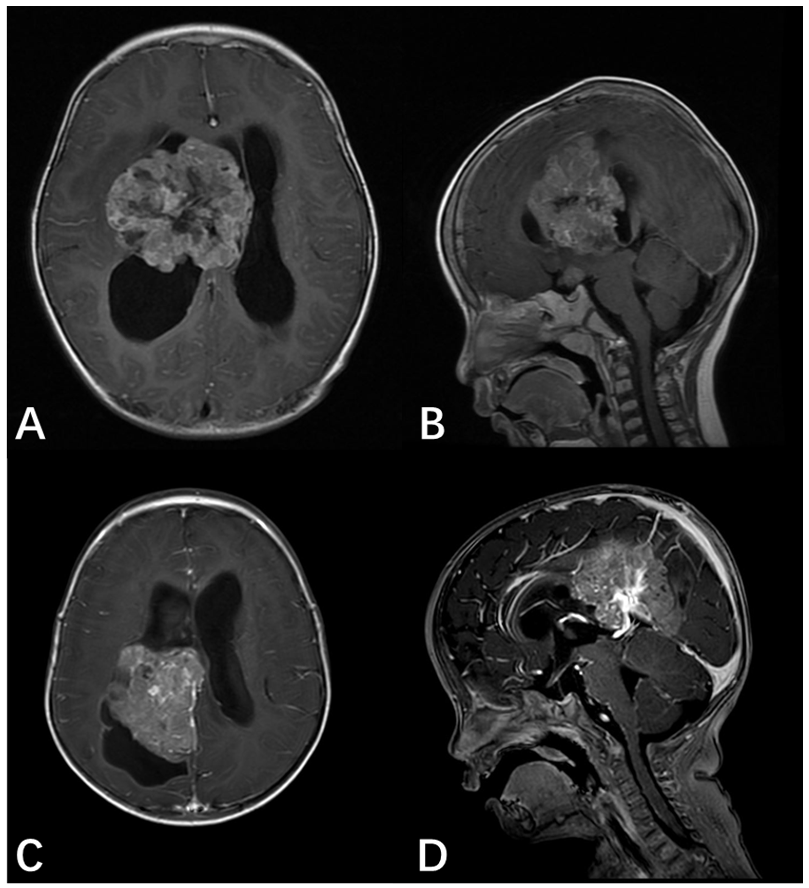 Atypical Teratoid/Rhabdoid Tumor of the Lateral Ventricle: A Case ...