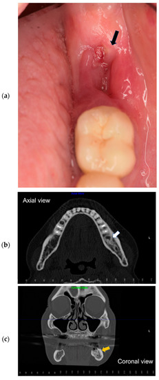 ONJ (MRONJ) Update 2021—Osteonecrosis of Jaw Related to Bisphosphonates ...