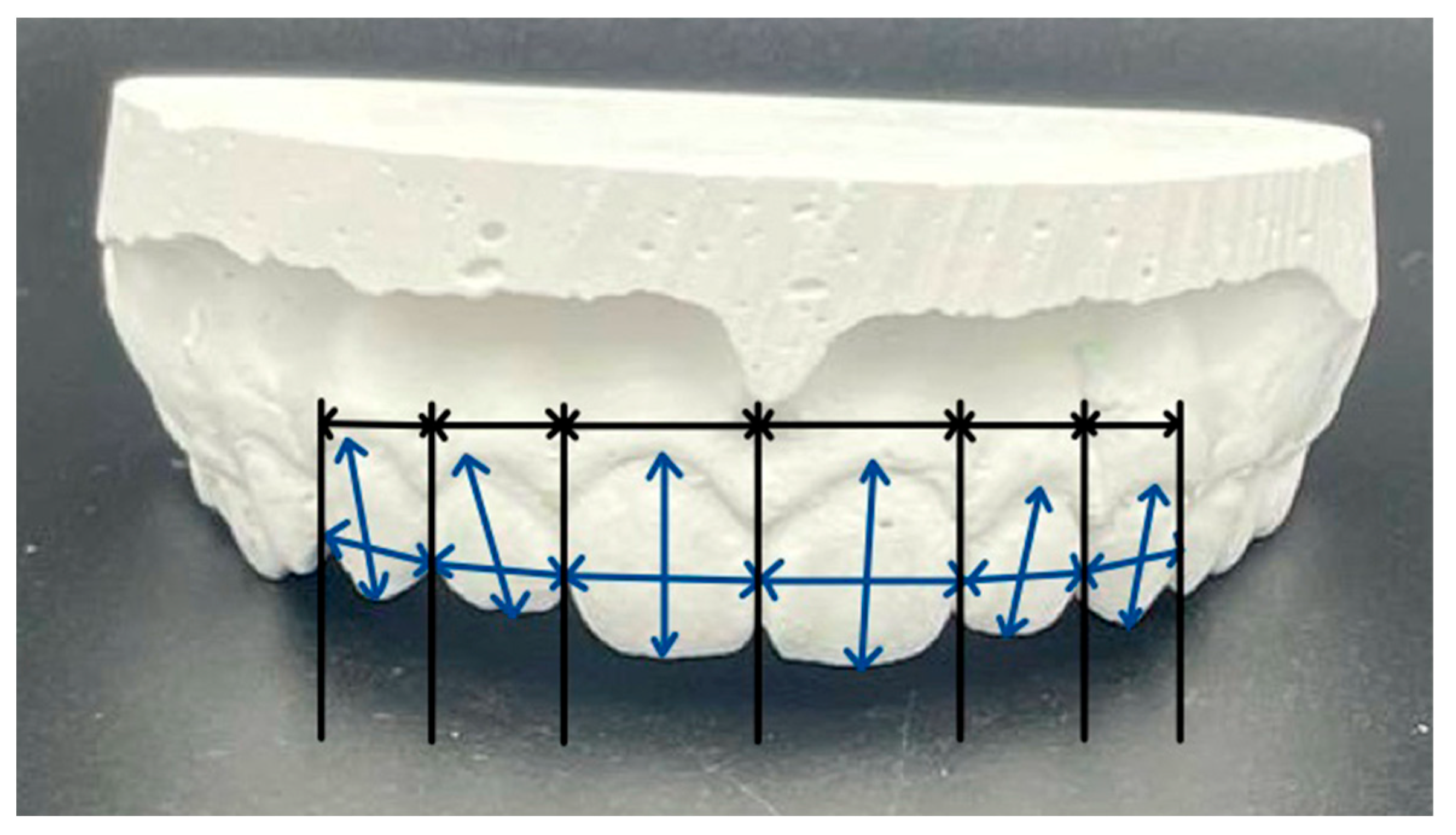 Analysis of Maxillary Anterior Tooth Dimensions and Proportions in ...
