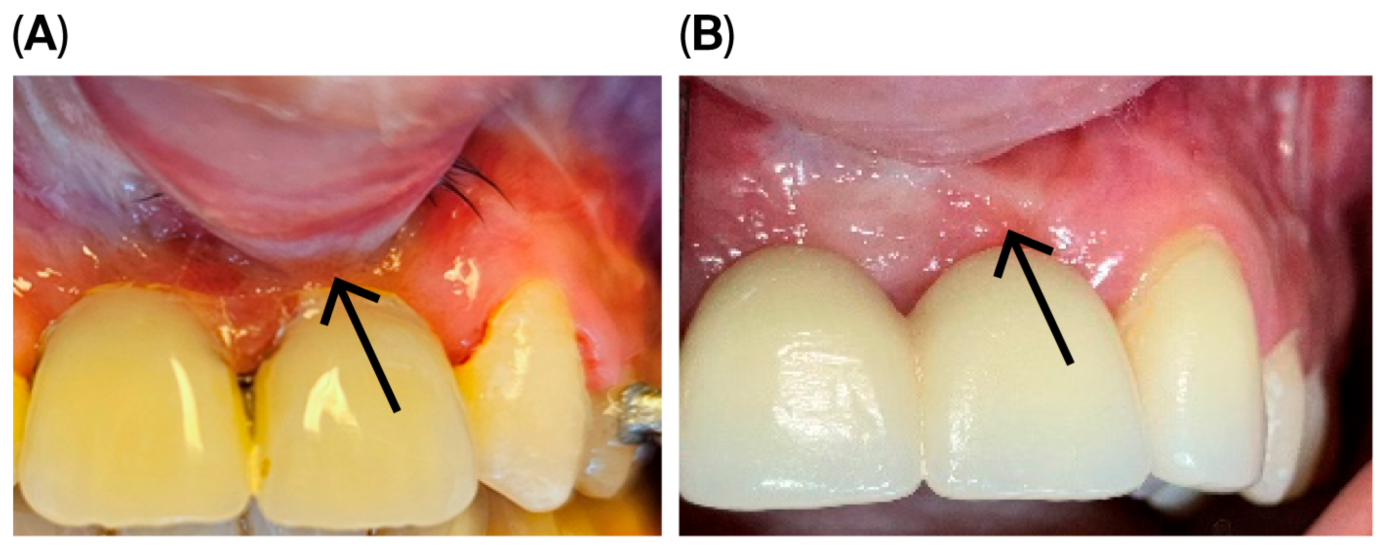 Acellular Fish Skin Graft as a Possible Alternative to Autogenous ...
