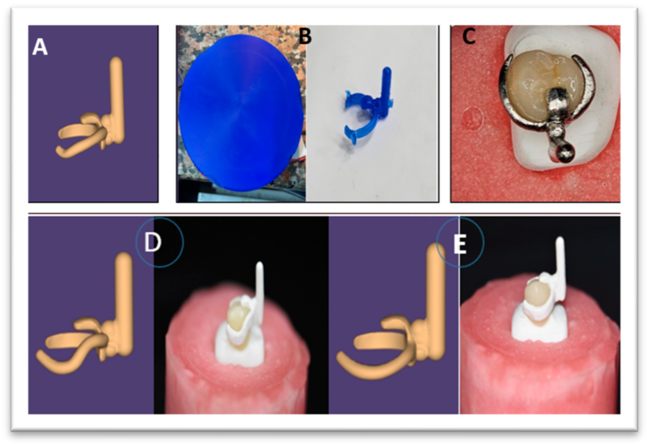In Vitro Assessment of Retention and Fit Precision in Cast, 3D-Printed ...